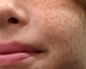 Léntigos seniles, solares, benignos y malignos – Cosmetologas